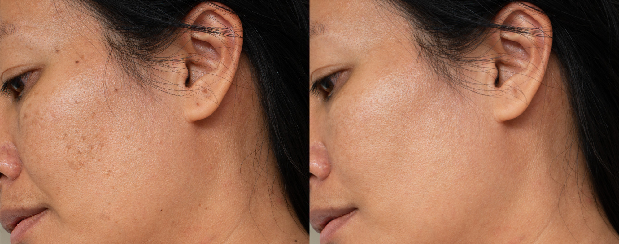 What causes hyperpigmentation – dark spots – on your face and how to ...