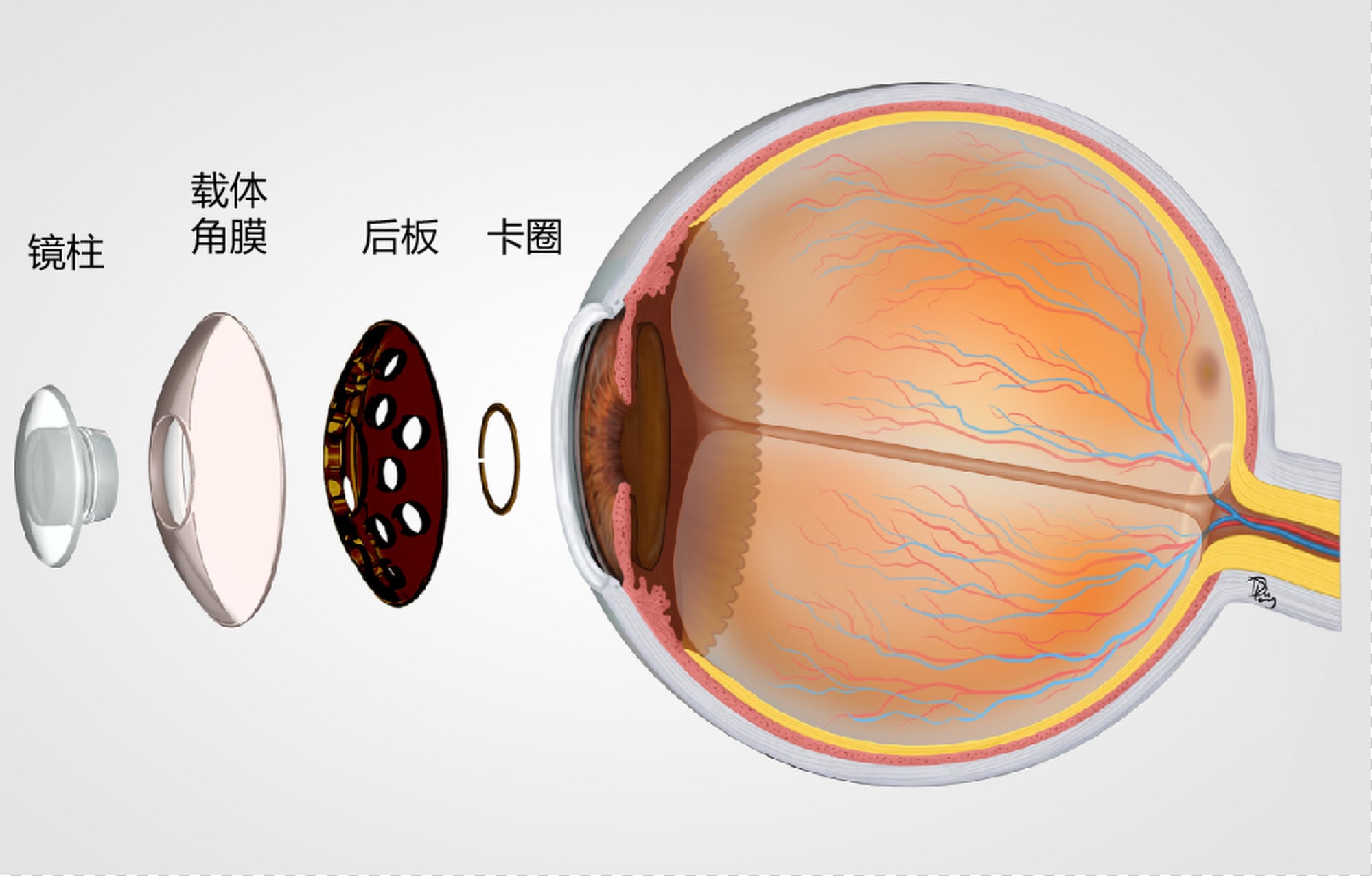 Made in China ‘last resort’ implant gives hope to eye injury patients ...