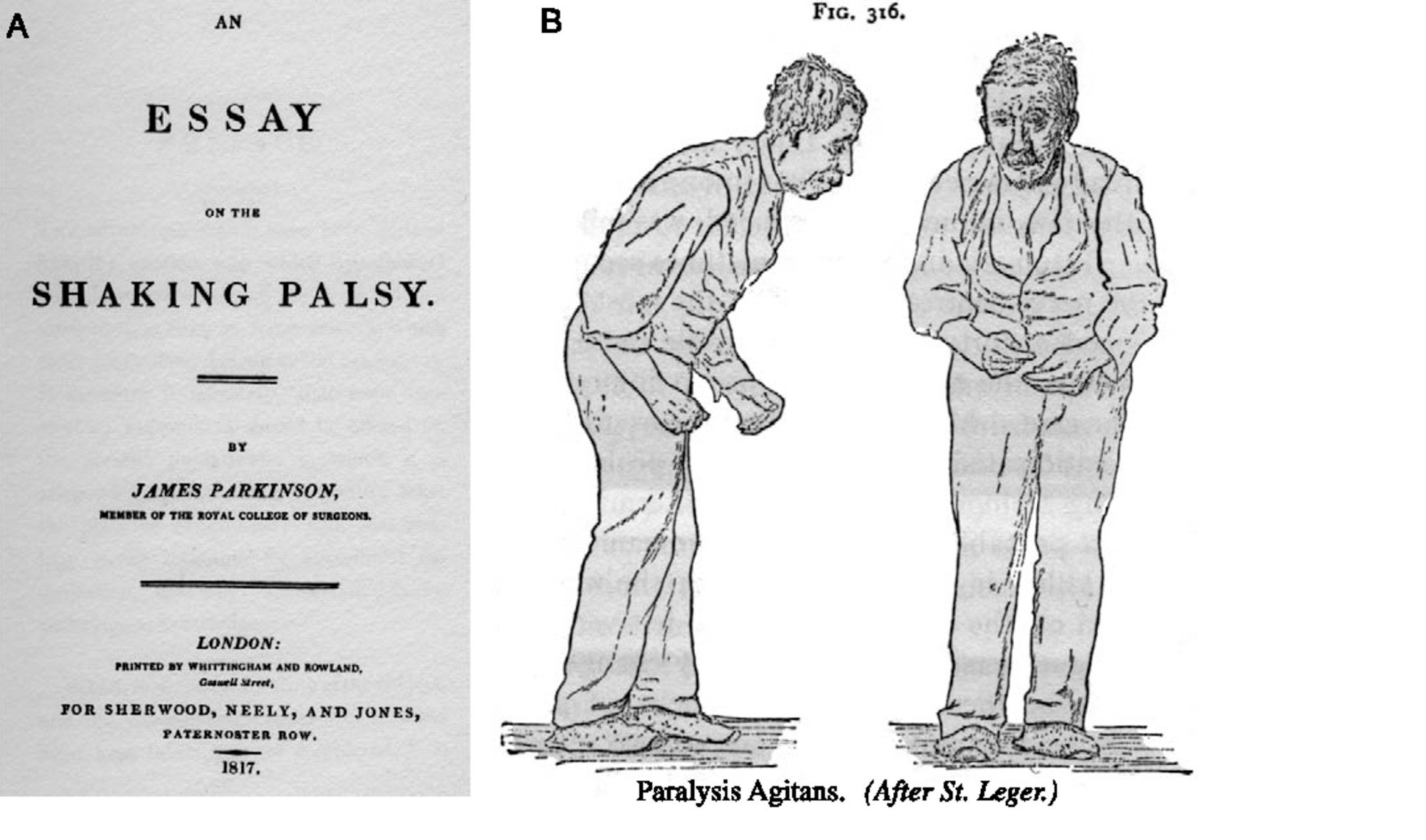 What is Parkinson’s disease? Symptoms, possible causes, treatment and progress towards a cure ...