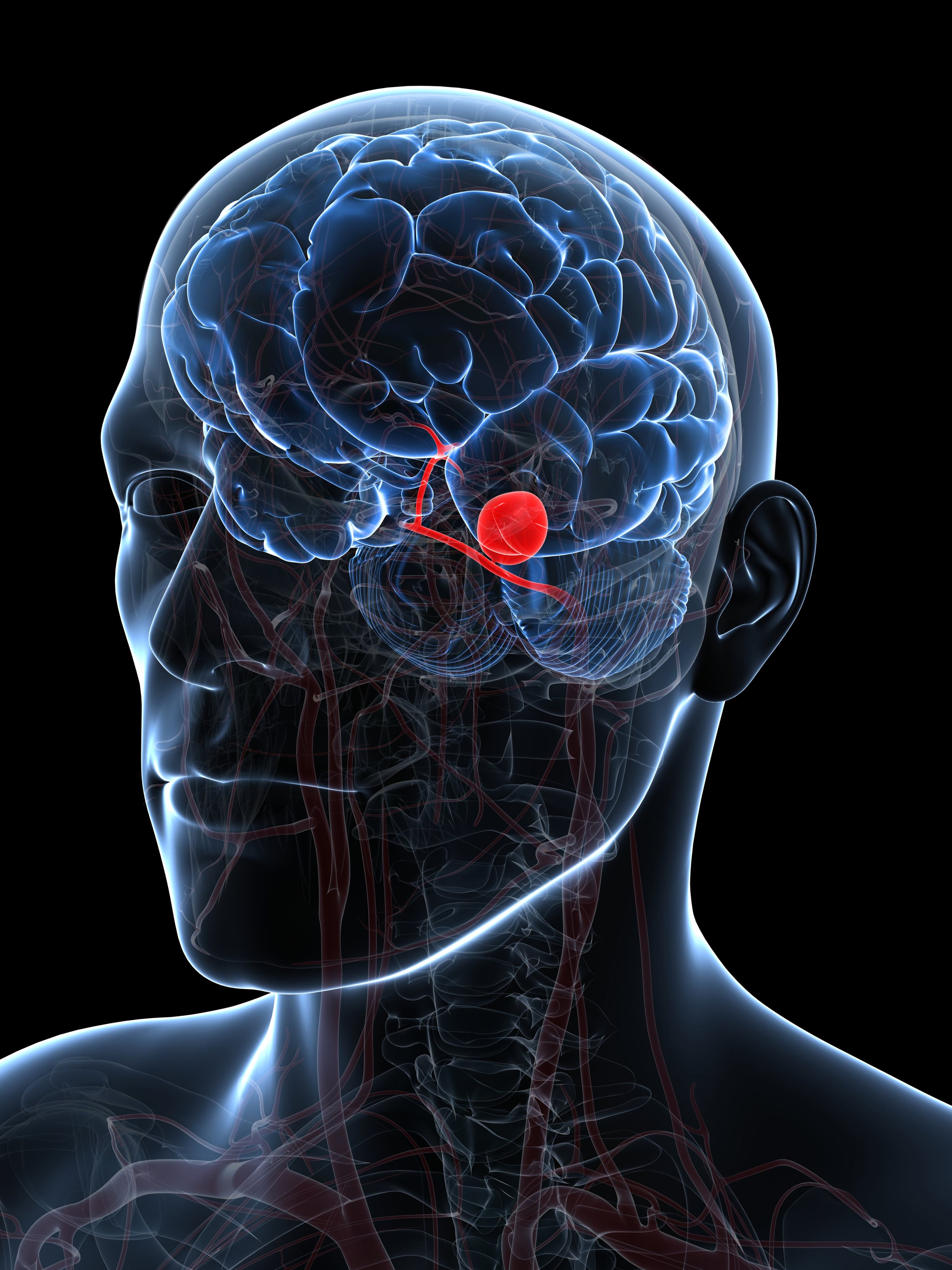 Cerebral Aneurysm Rupture