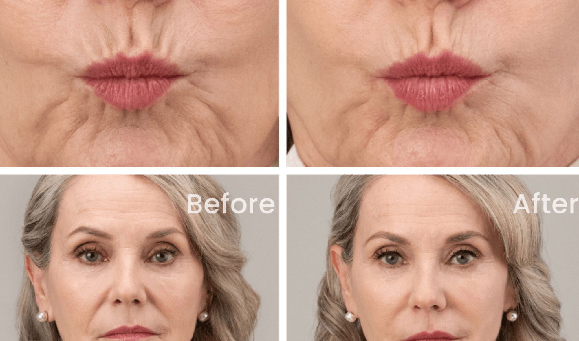 Move over, Botox? 5 new FDA-approved fillers to try: from Daxxify’s ...
