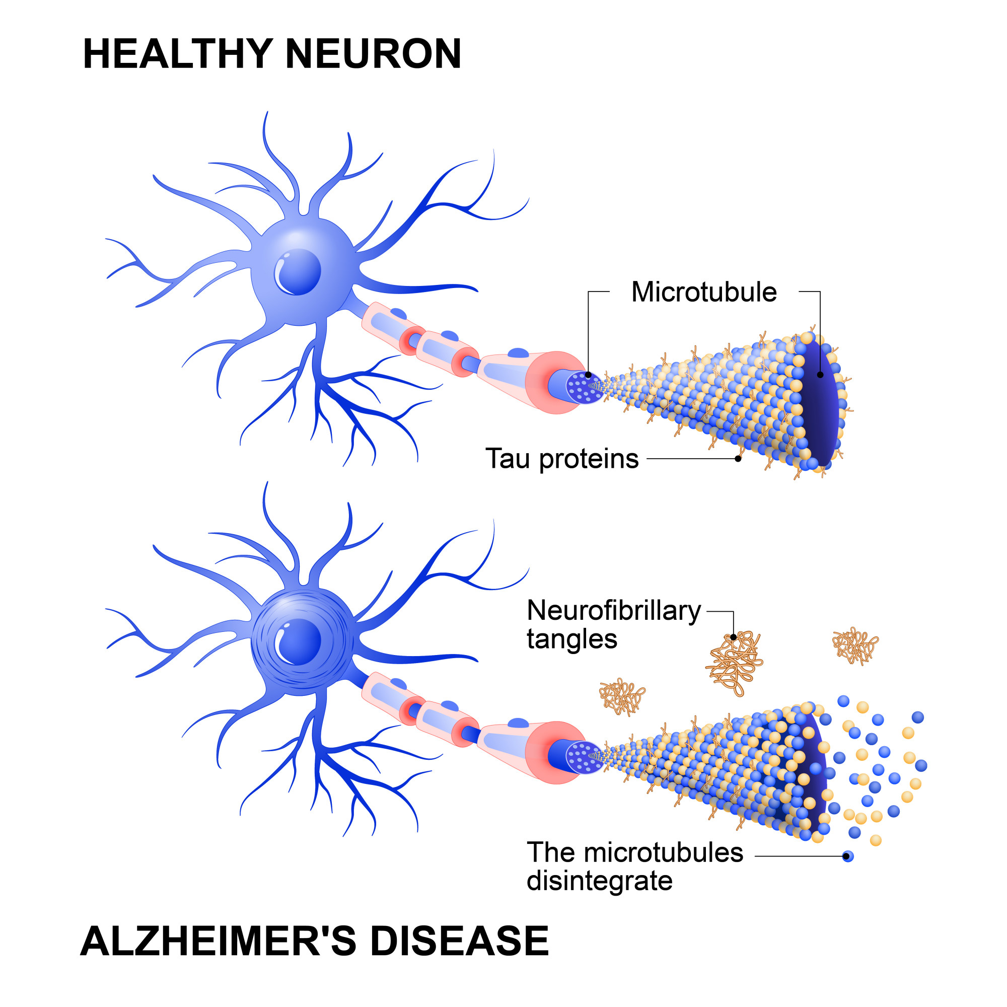 Unravelling 2 Alzheimer s Markers What Are Amyloid Plaques And Tau Unravelling 2 Alzheimer s Markers What Are Amyloid Plaques And Tau