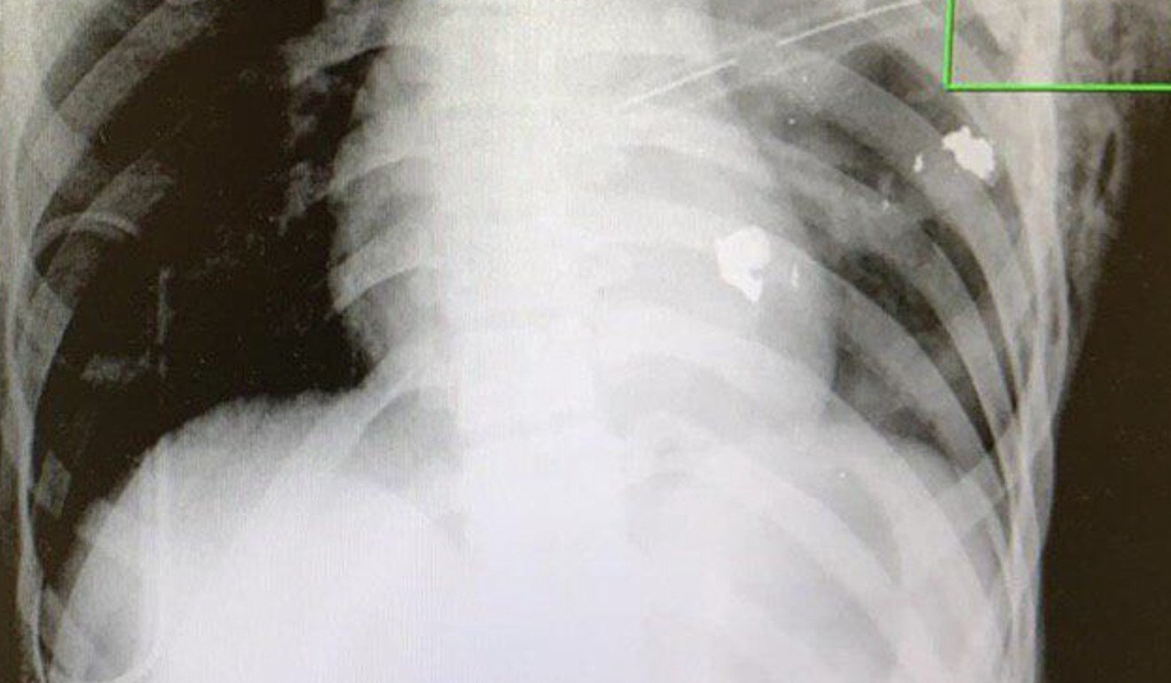 Secondary school student in stable condition after being shot with live ...