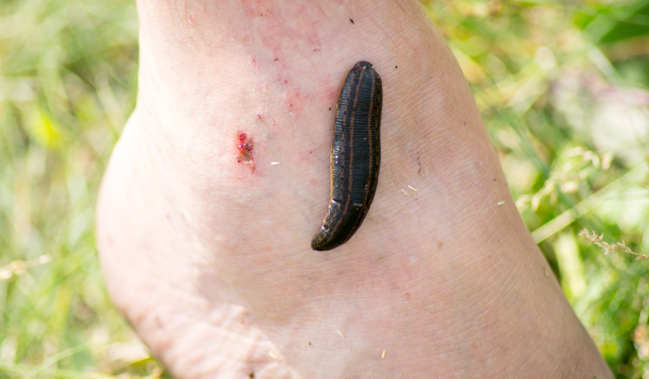 How leeches could help prevent future coronavirus outbreaks: blood ...