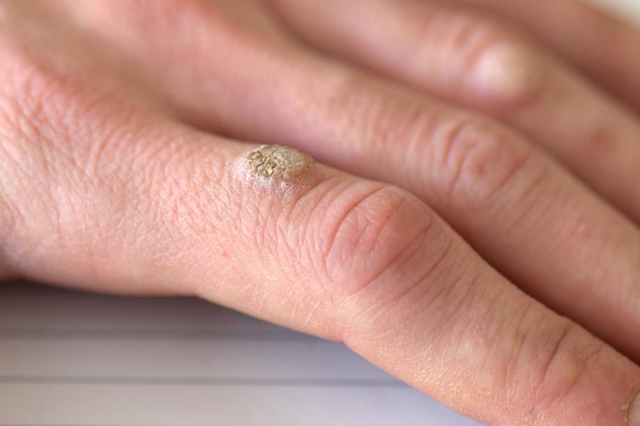 Now you know What are warts and how do you get rid of them Young Post South China Morning Post