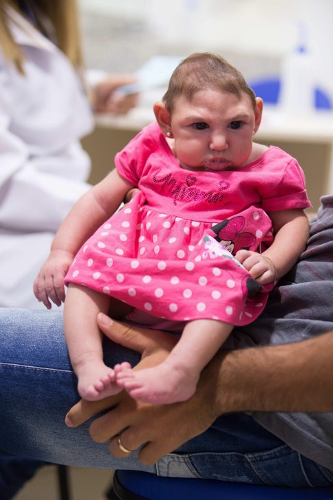 Small Head Disease