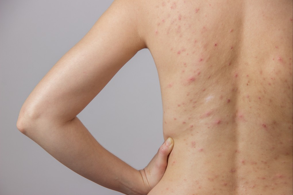 back acne without steroids