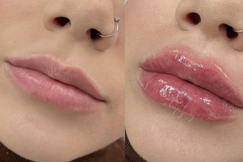 The hyaluron pen a TikTok fave gives you fuller lips at home but experts warn it s not safe South China Morning Post