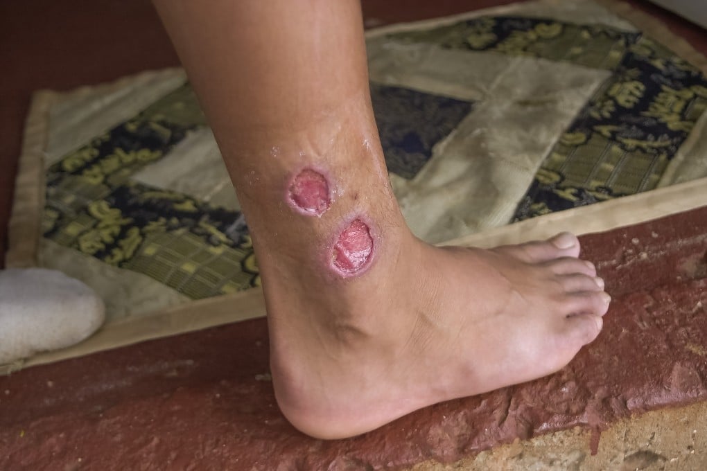 cutaneous infection examples