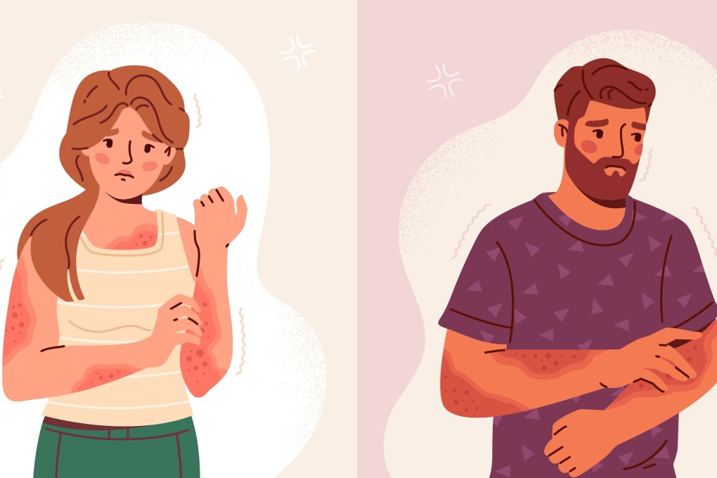 Dermatologist explains all about heat rash and how you can ditch the ...