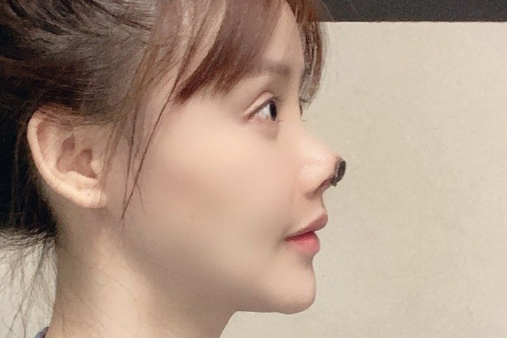 bad nose job pictures