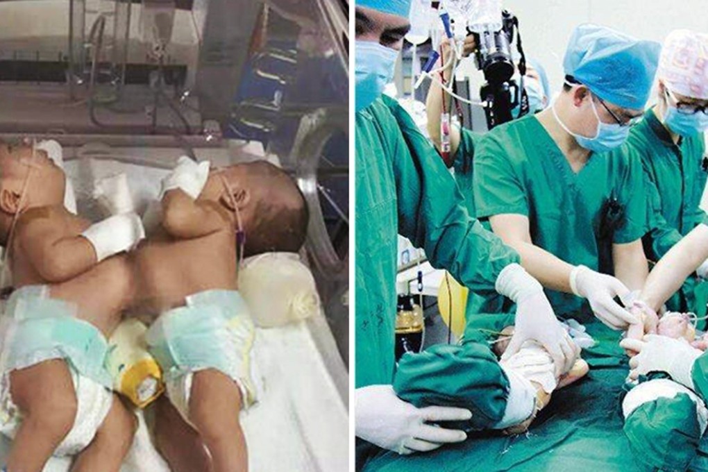 siamese twins operation