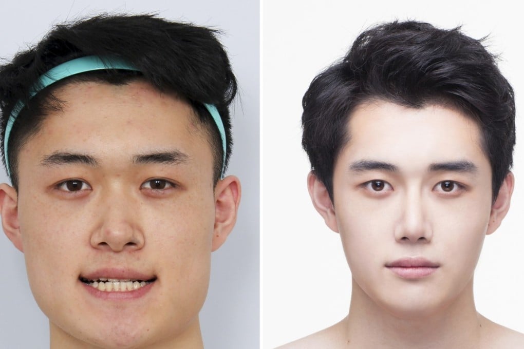 kpop plastic surgery guy