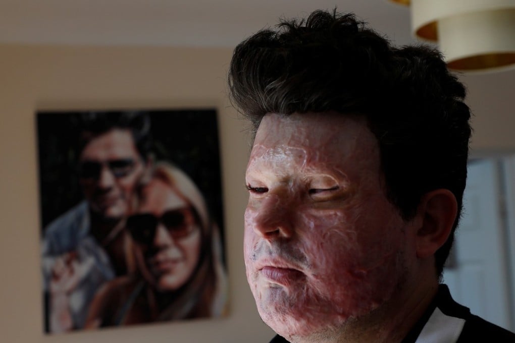 After spate of acid attacks, UK gets tough with longer sentencing ...