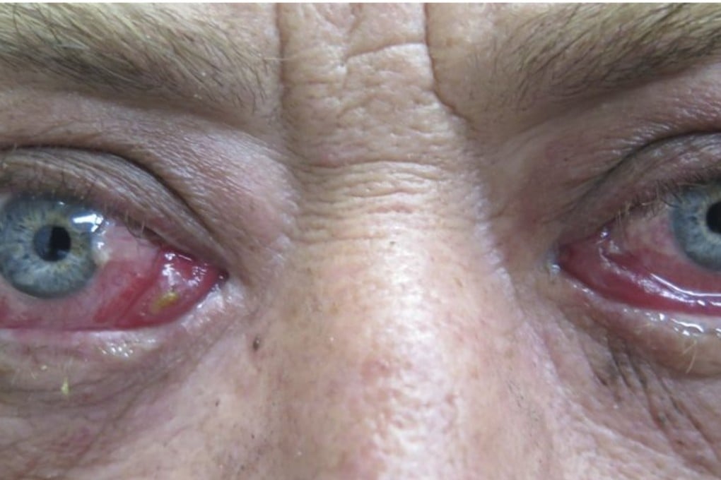 glaucoma red eye