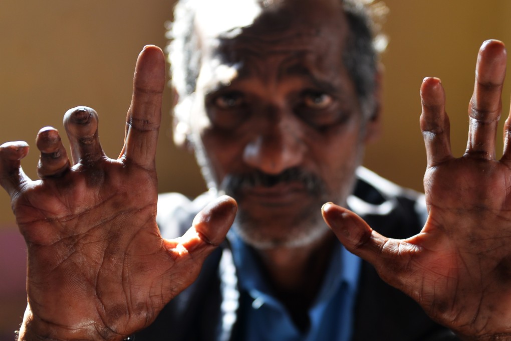 leprosy hands
