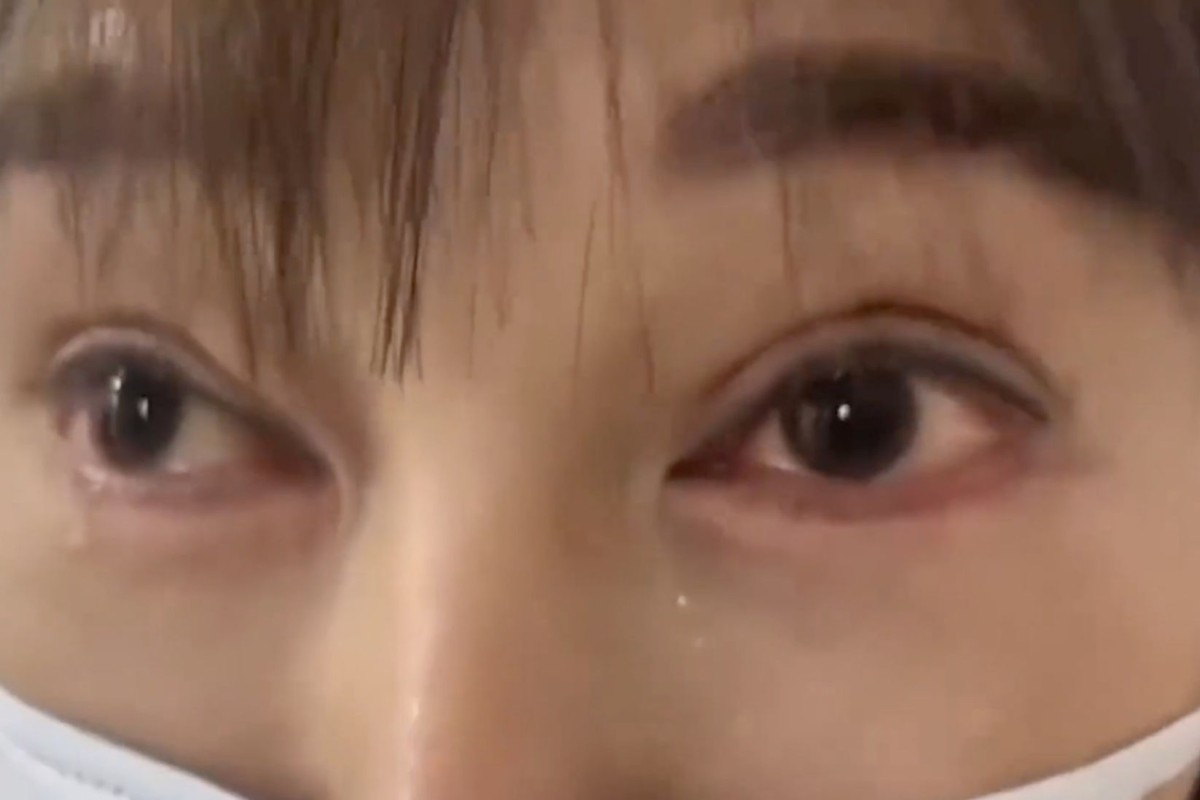 Botched double eyelid surgery store