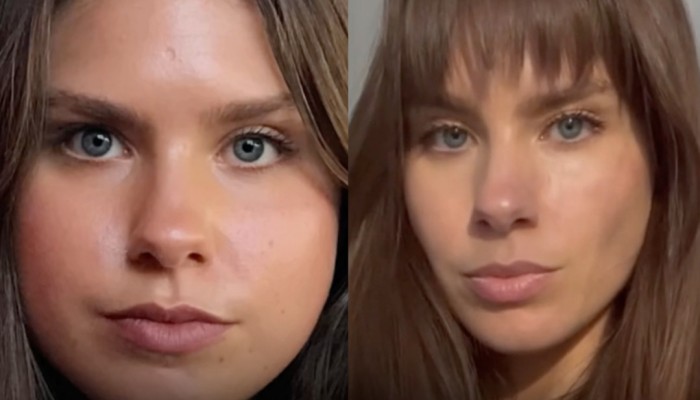 moon face side effect