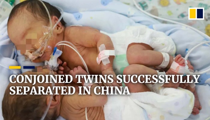 Conjoined twins successfully separated in China | South China Morning Post