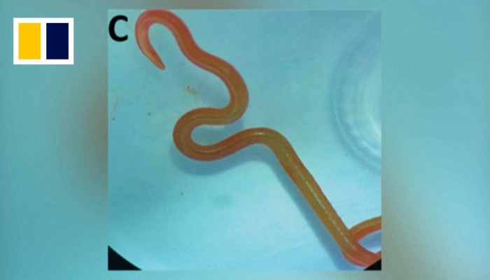 Living worm removed from Australian woman's brain in first known case ...