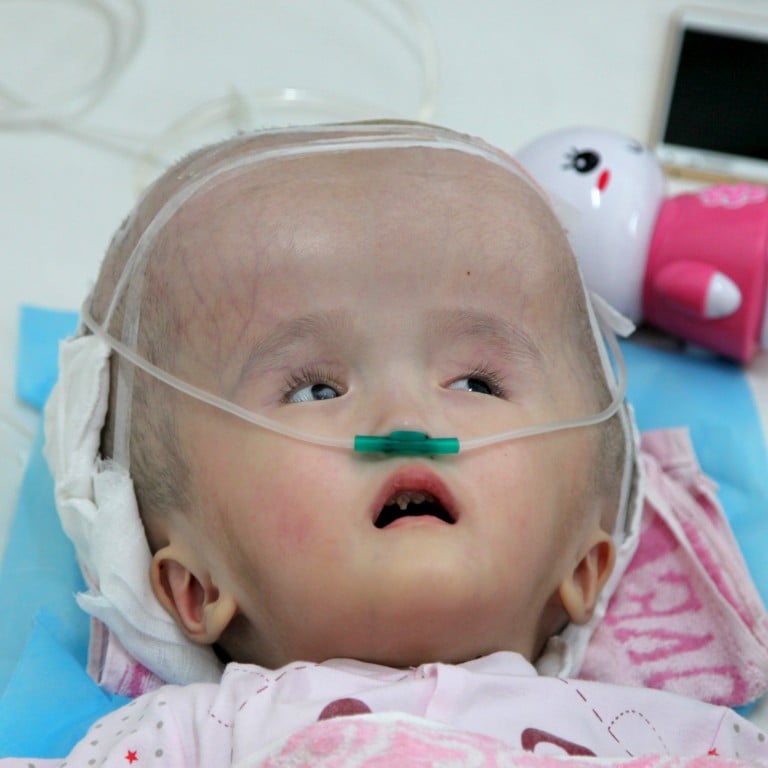 Chinese 3-year-old with swollen head saved by first ever 3D-printed ...