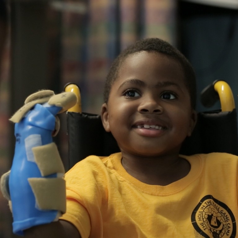 Boy, 8, has world's first child double hand transplant | South China ...
