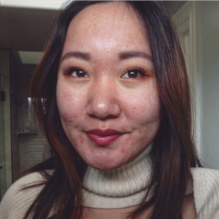 She’s not ashamed of her acne any more: how the skin positivity ...