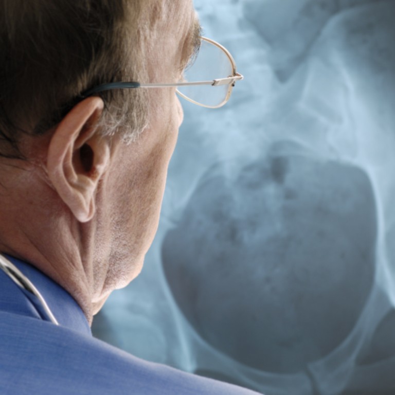 World Osteoporosis Day: how to spot the bone thinning condition early ...