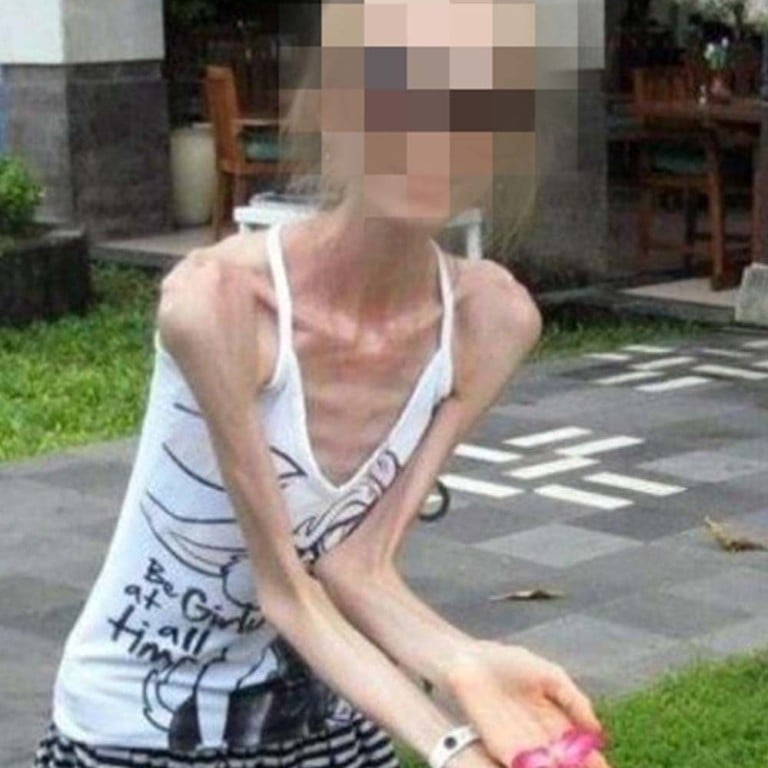 Chinas Beauty Slimness Obsession Highlighted After Womans Weight Drops To 25kg In A Year With