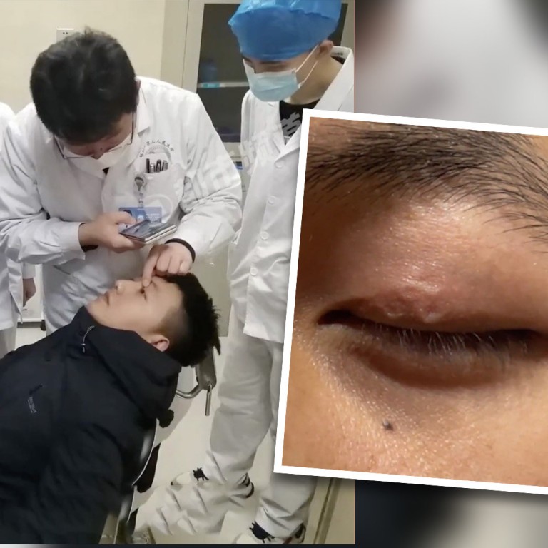 ‘Scary’ video of parasitic worms in man’s eyelid trends in China after ...