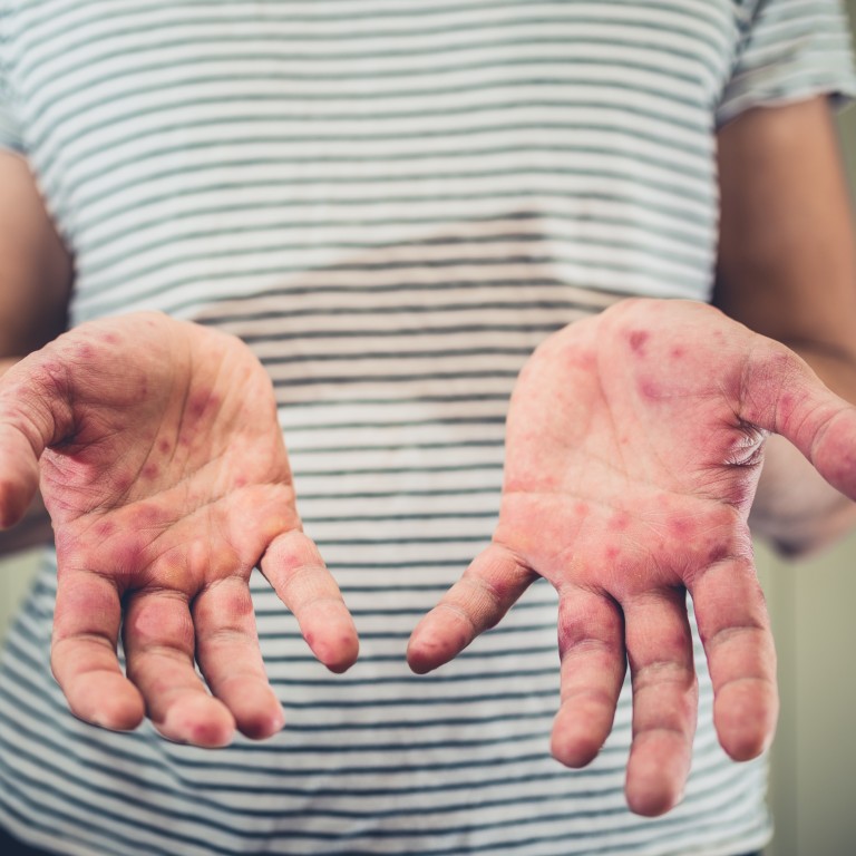 What is behind uptick in infectious diseases among children in Hong ...