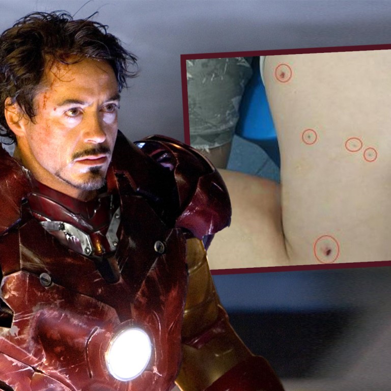 Iron Man antics: China blast victim tries to remove metal shards from ...