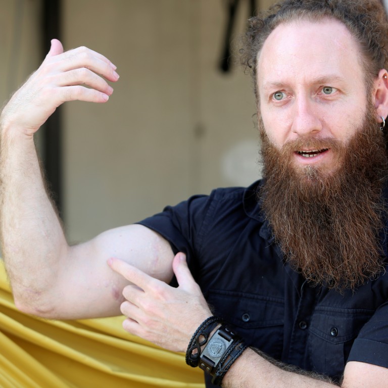 A year on, doctors still plucking glass from Beirut blast survivor’s ...