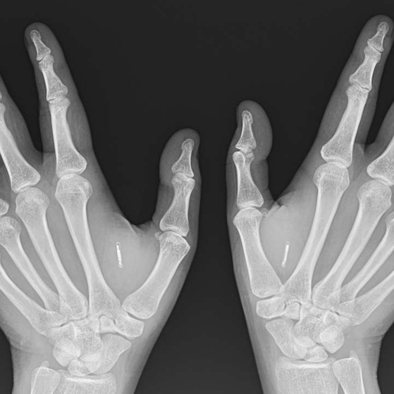 Microchip implants give Jedi powers to lifelong Star Wars fan | South ...