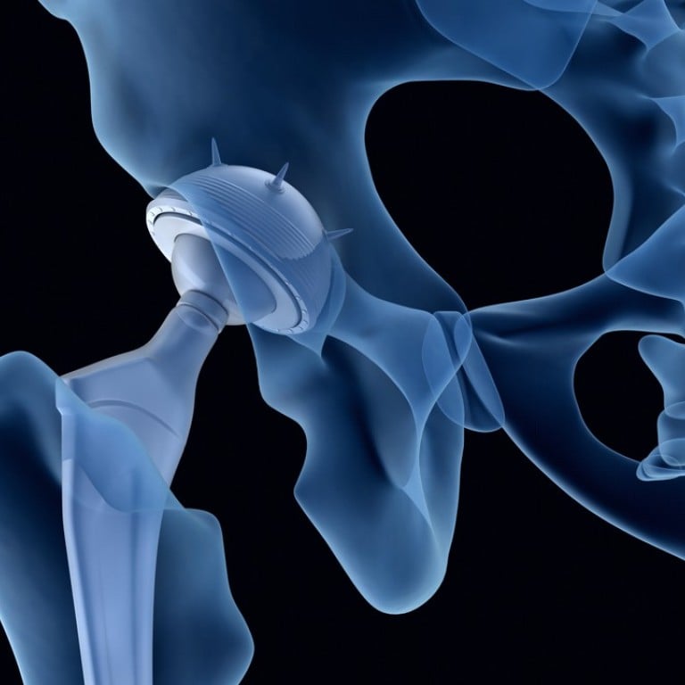 Indian victims of faulty hip implants wait on compensation, years after ...