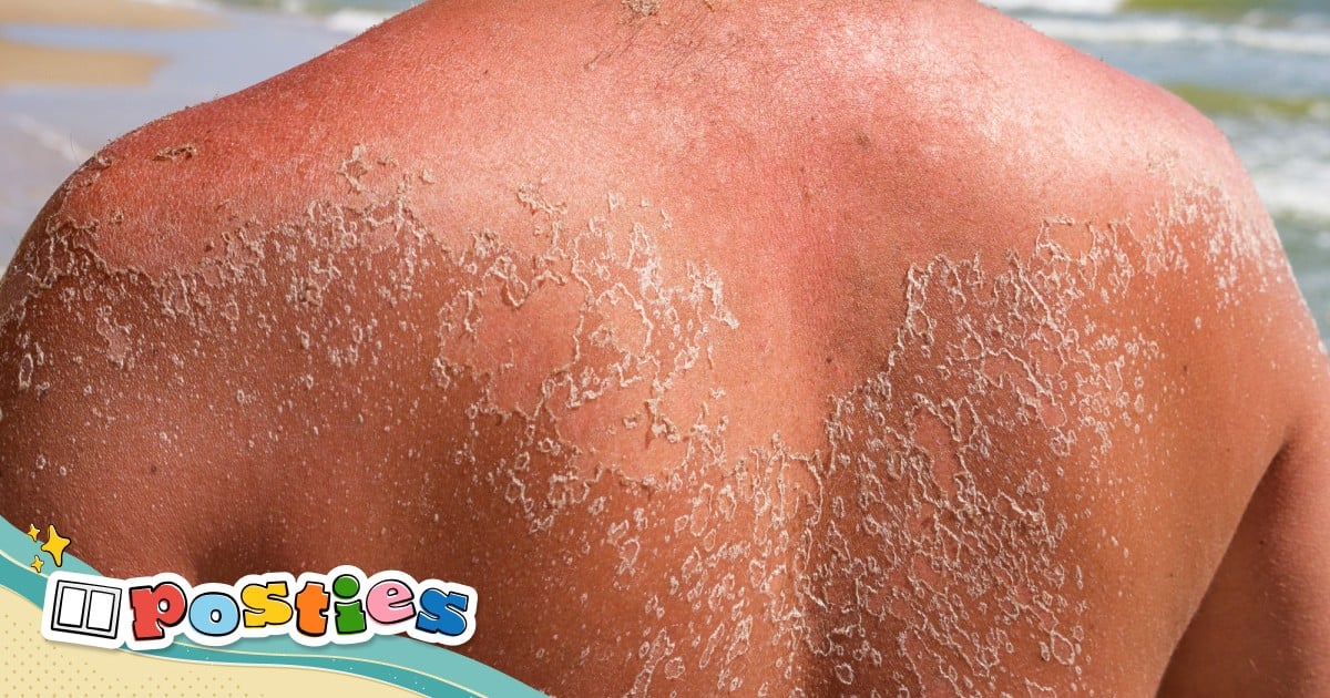 Sunburn Peeling Back