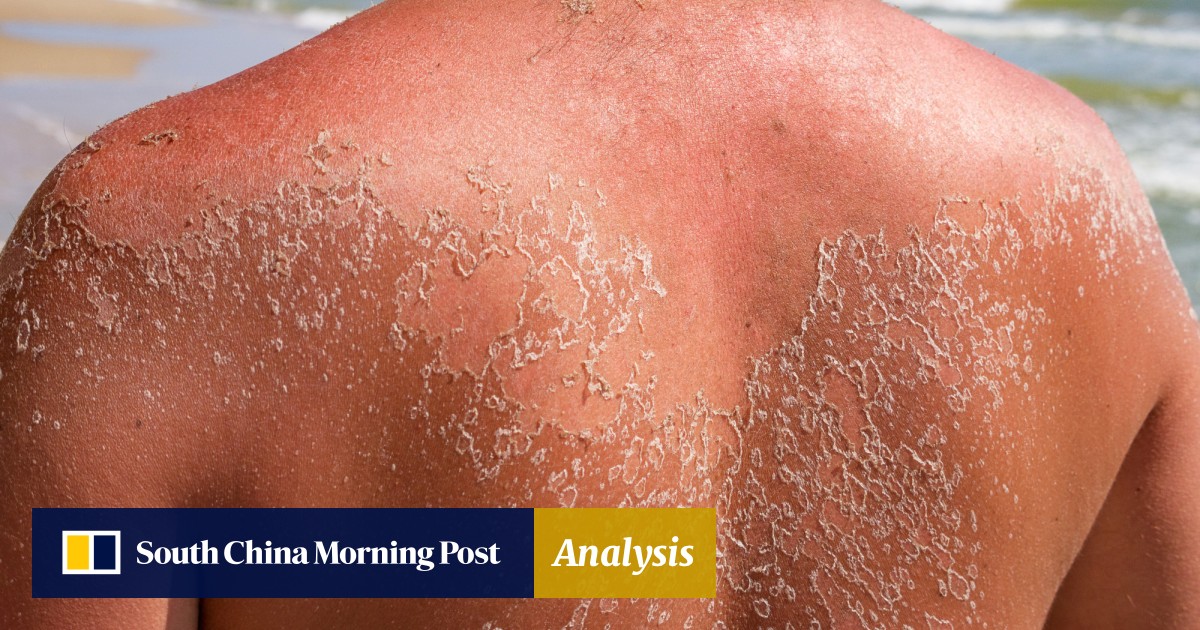 Sunburn Peeling Back