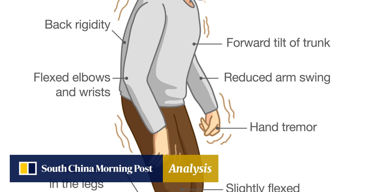 does parkinson's affect posture
