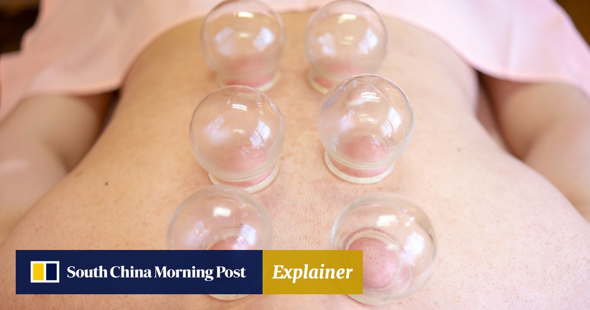 chinese cupping tutorial