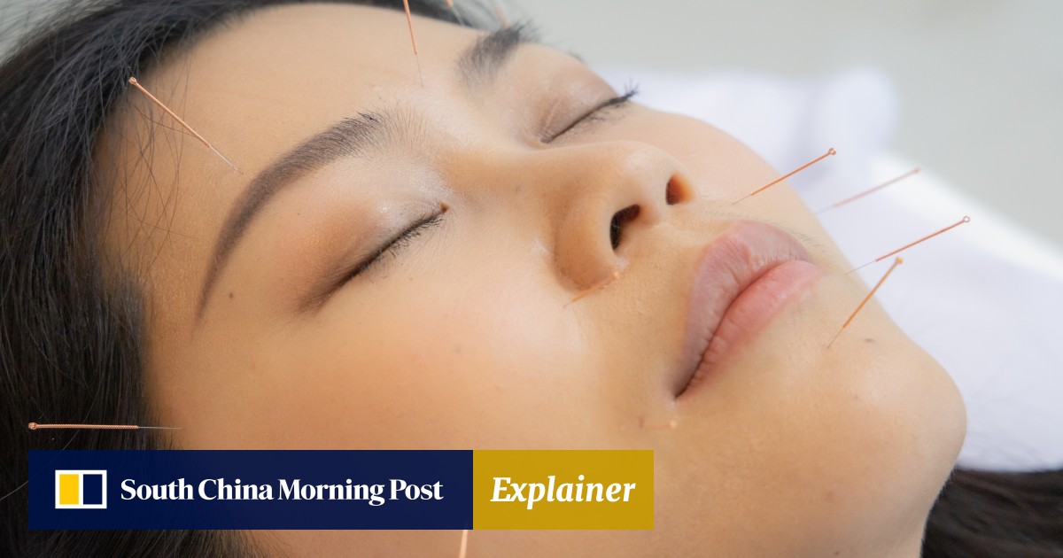 Explainer | Acupuncture – how the traditional Chinese medicine (TCM ...