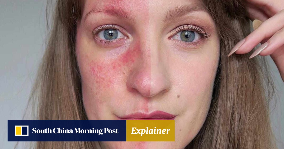 Explainer | What is rosacea? Causes, symptoms and treatments of a ...