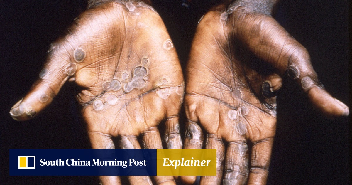 How concerned should we be about monkeypox? | South China Morning Post