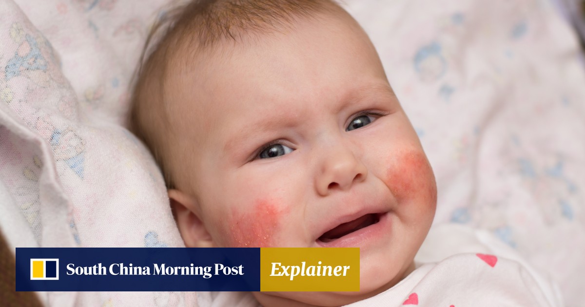 Explainer | How to tell the difference between eczema and psoriasis, so ...