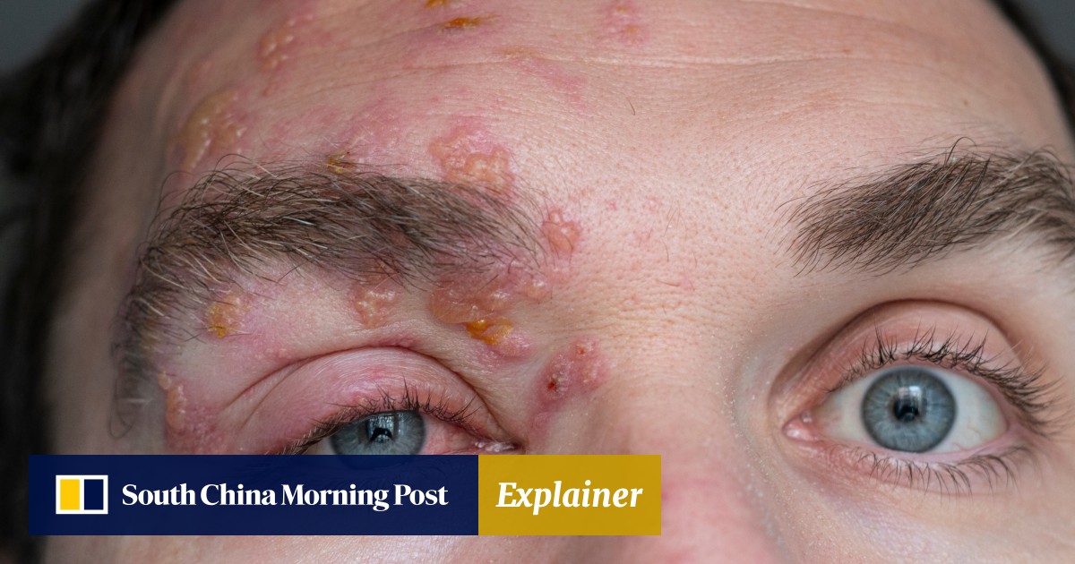 Explainer | Why ‘growing snakes’ – shingles – is so painful and how to ...