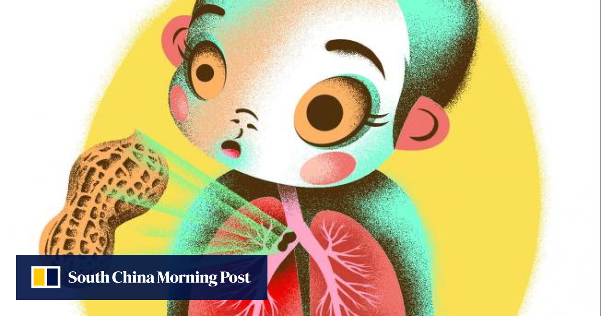 Case history: peanut aspiration | South China Morning Post