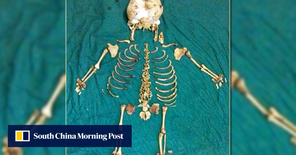 Fetus’ skeleton removed from woman 36 years after miscarriage | South ...
