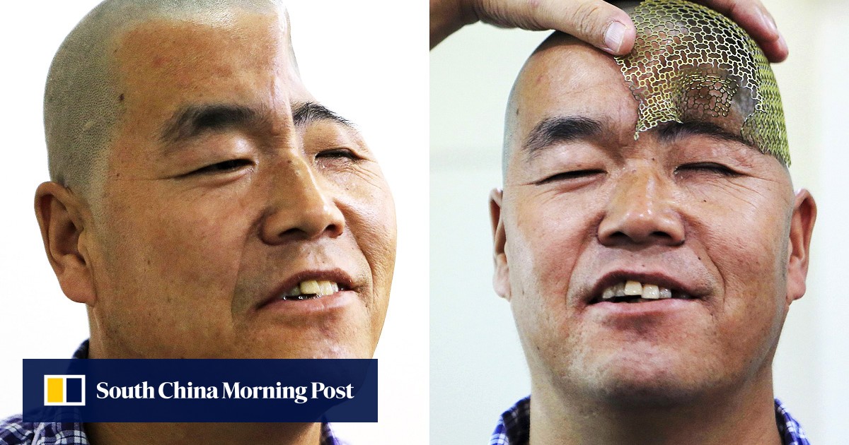Chinese farmer whose head was crushed will be fitted with 3D-printed ...