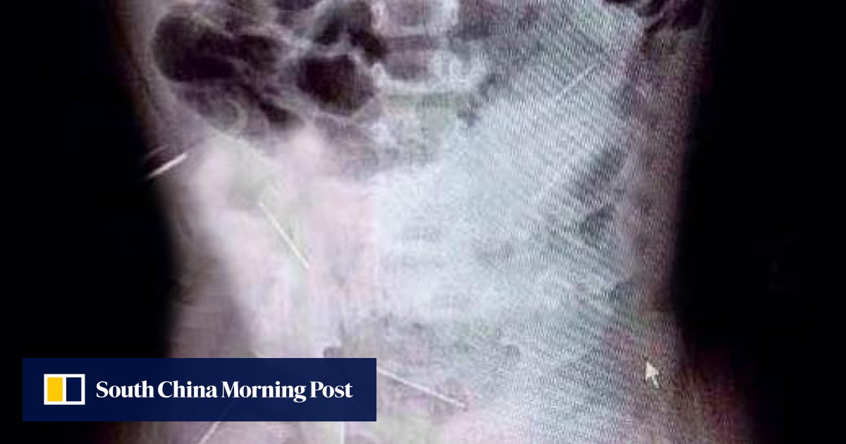 Chinese baby girl has 12 sewing needles deliberately inserted into her ...