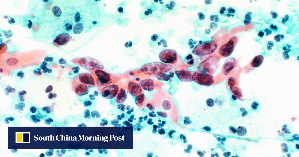 Colon cancer linked to viruses in beef, Nobel-winning scientist ...