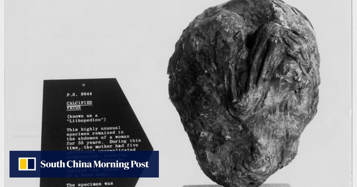 The ‘stone baby’: For more than 50 years, she carried her unborn child ...